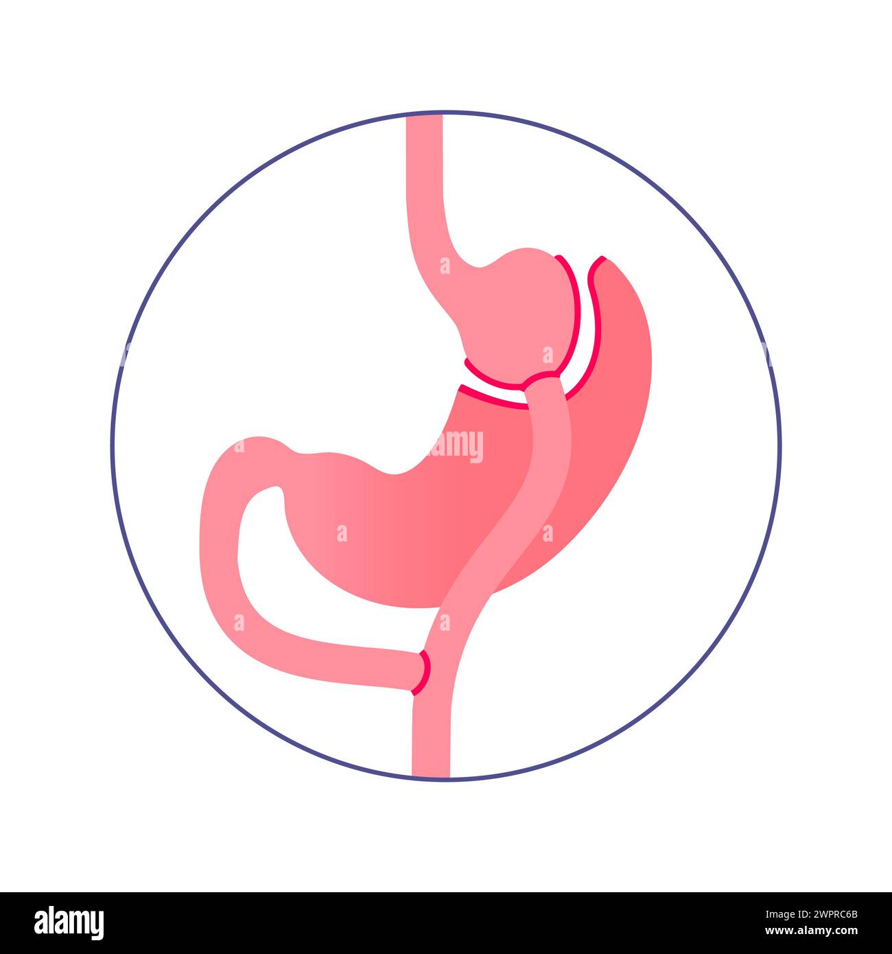 Gastric bypass gastroplasty operation, illustration. Roux-en-Y Gastric Bypass (RYGB) stomach ...