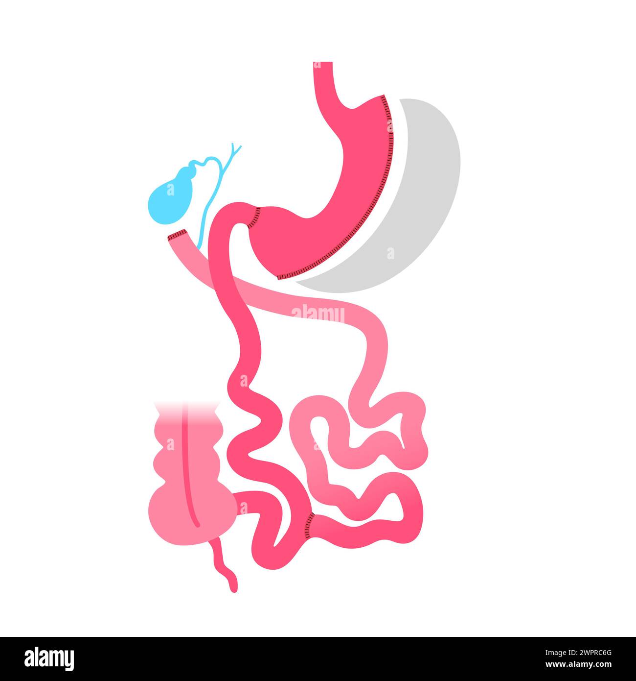 Biliopancreatic diversion procedure, illustration Stock Photo - Alamy