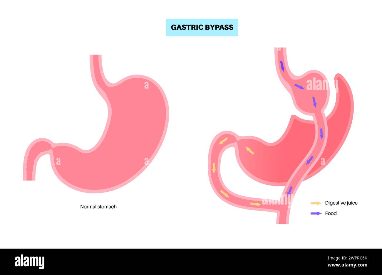 Gastric bypass surgery, illustration Stock Photo - Alamy