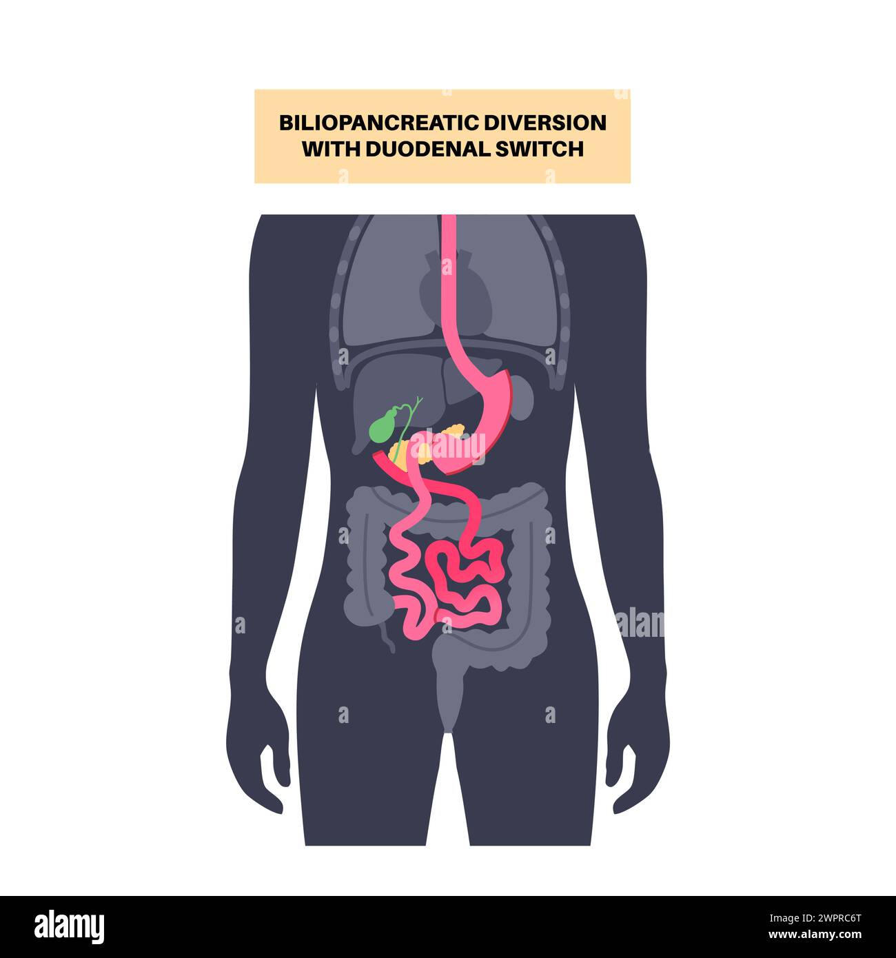 Biliopancreatic diversion (BPD) with duodenal switch, illustration ...
