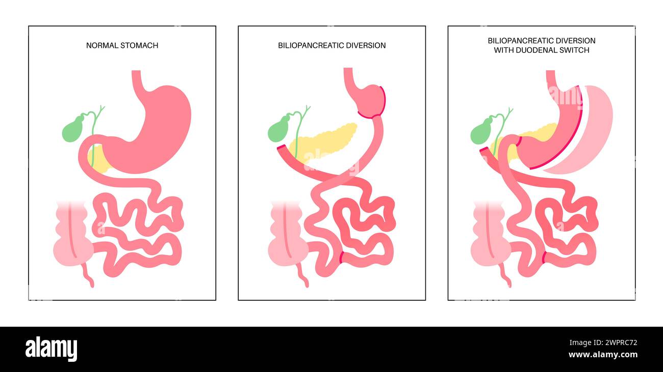 Biliopancreatic diversion (BPD) with duodenal switch, illustration. BPD ...