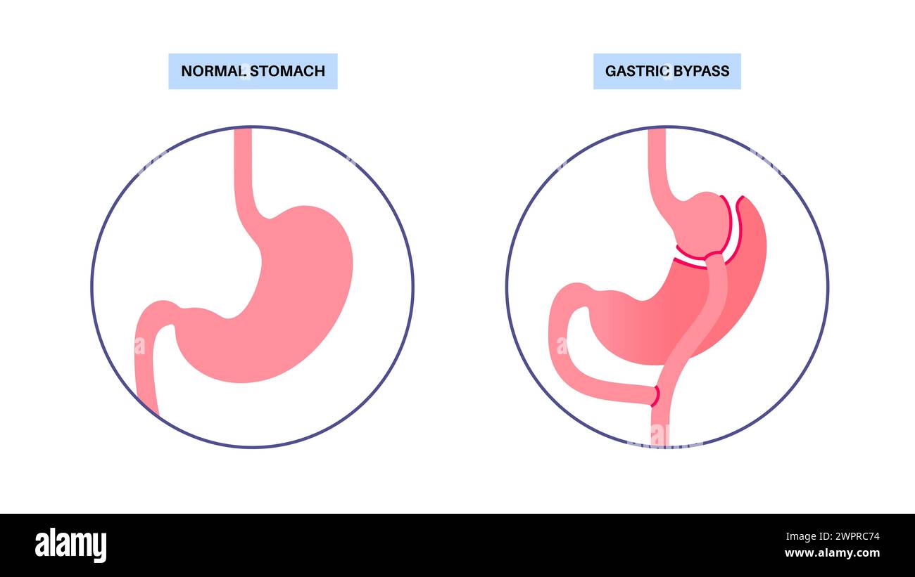 Gastric bypass surgery, illustration Stock Photo - Alamy