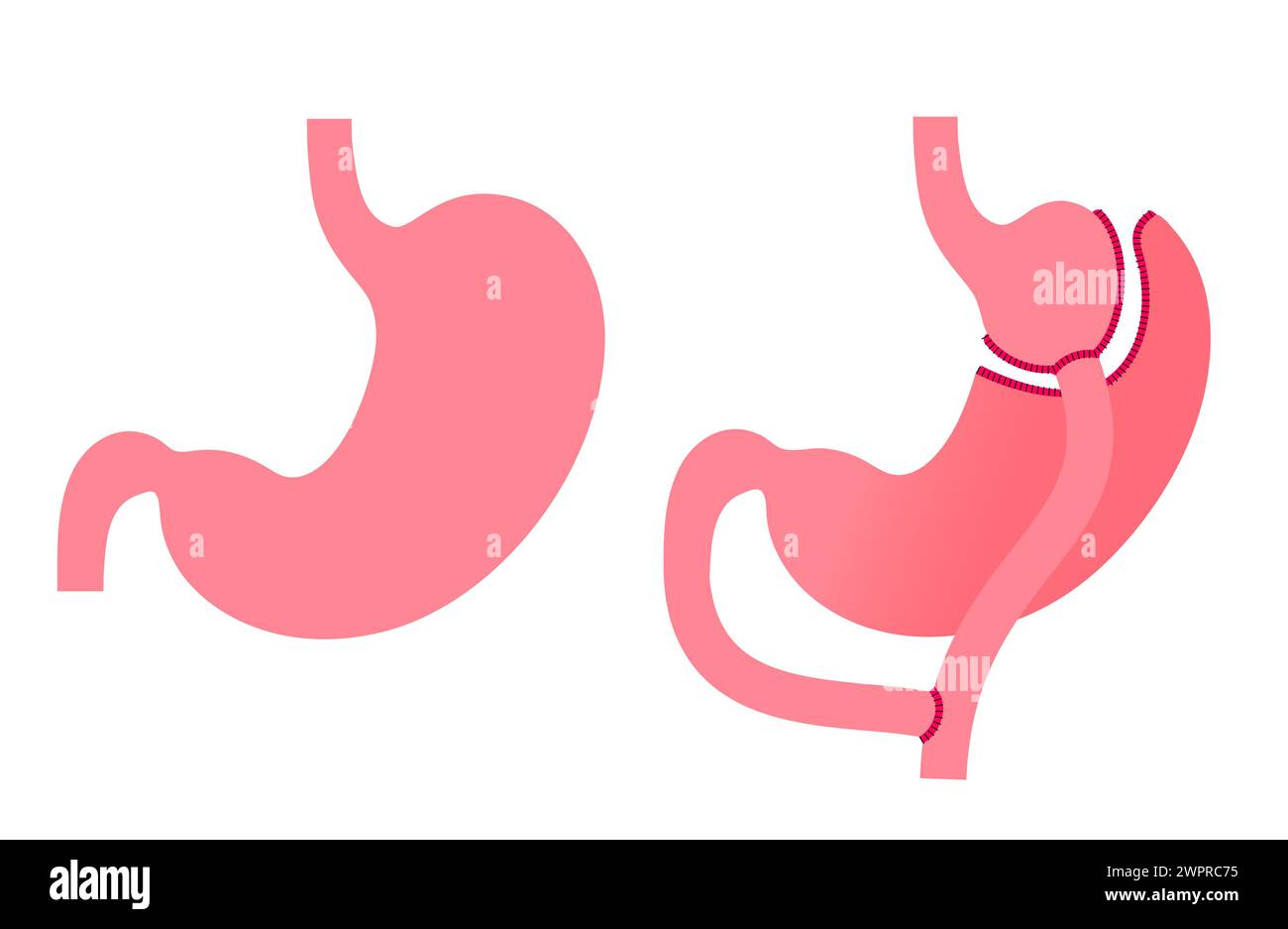 Gastric bypass surgery, illustration Stock Photo - Alamy