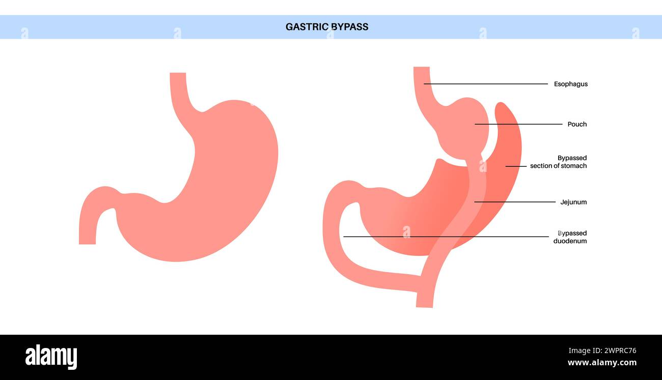 Gastric bypass gastroplasty stomach operation illustration. Human ...