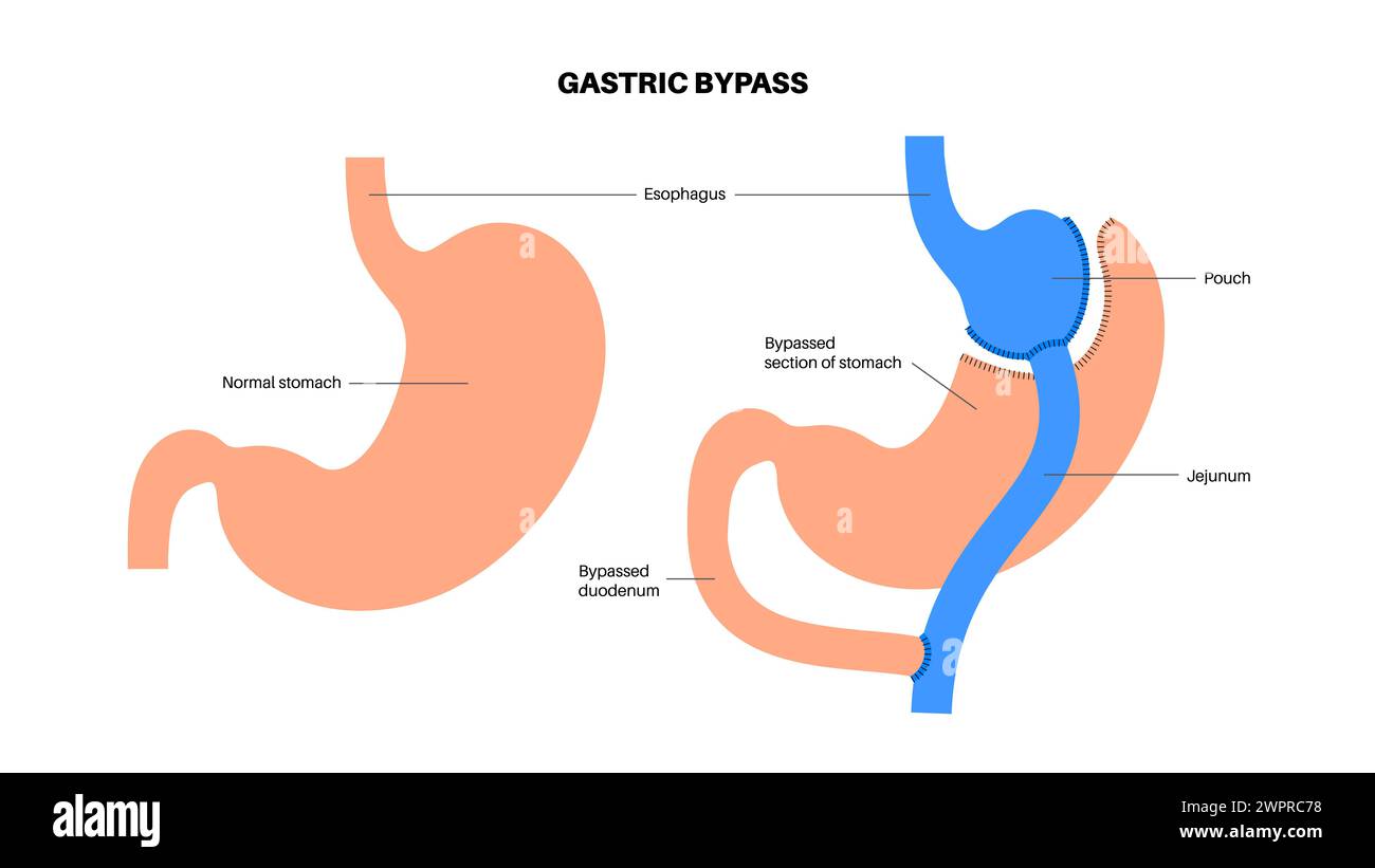 Gastric bypass surgery, illustration Stock Photo - Alamy
