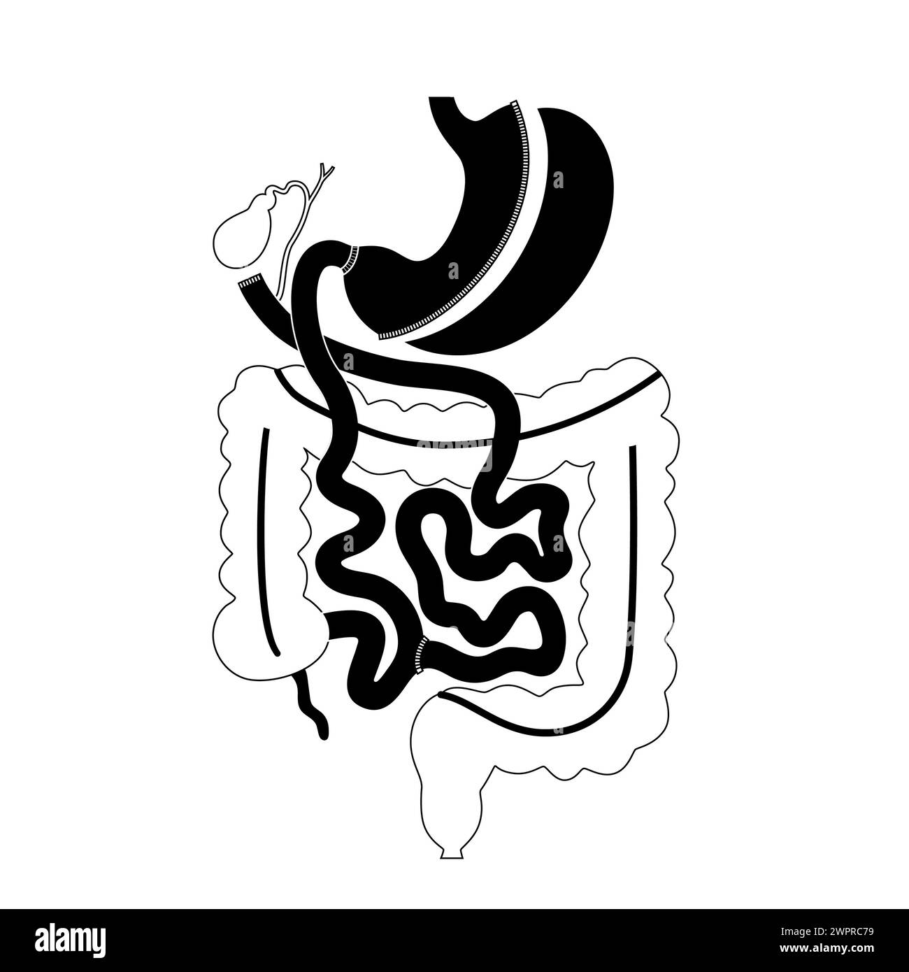 Biliopancreatic diversion procedure, illustration Stock Photo - Alamy