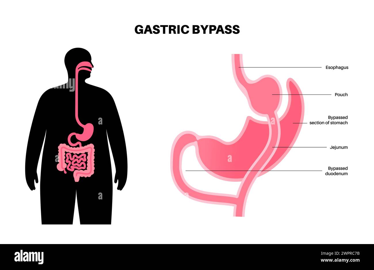 Gastric bypass surgery, illustration Stock Photo - Alamy