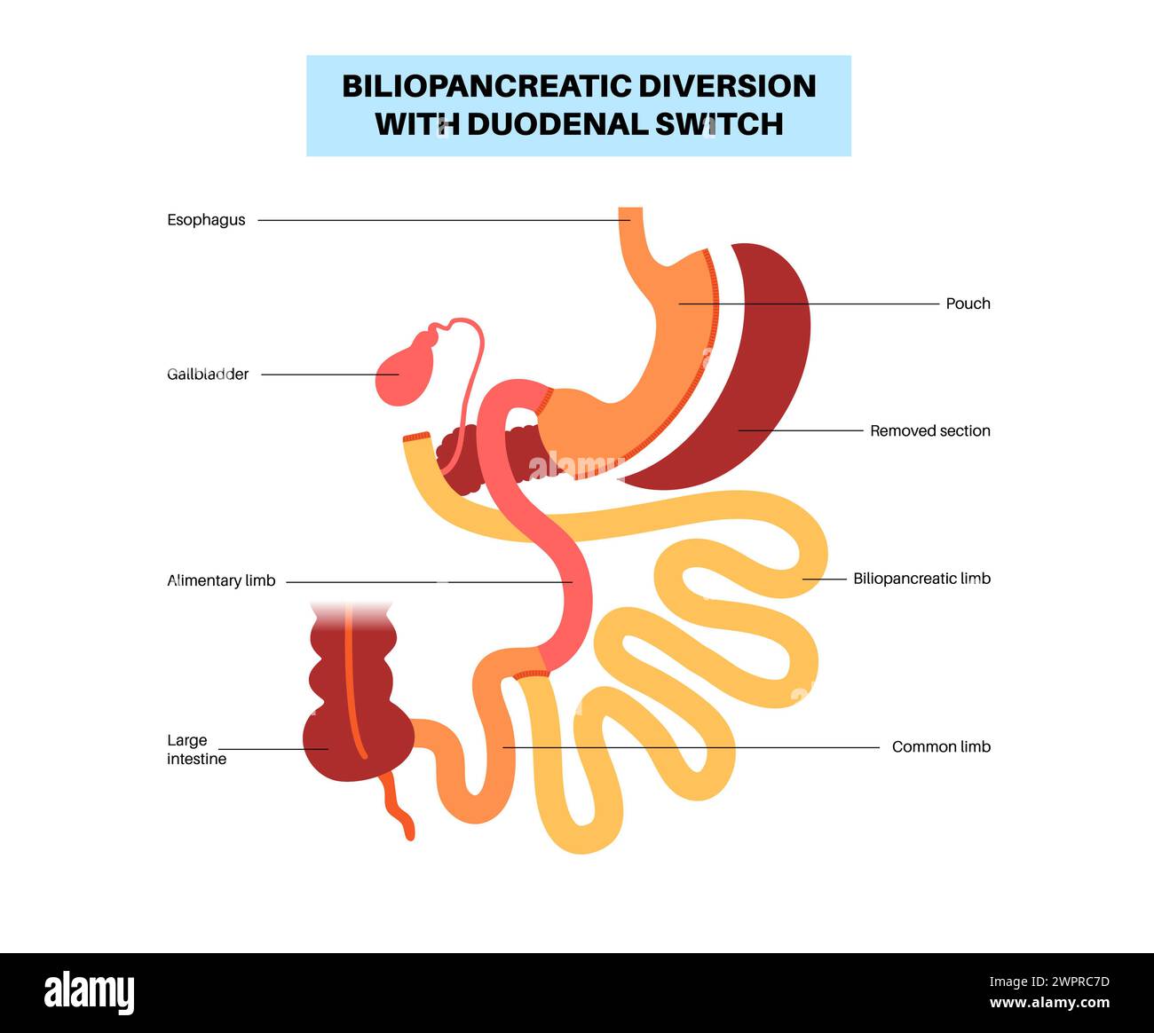 Biliopancreatic diversion (BPD) with duodenal switch, illustration ...