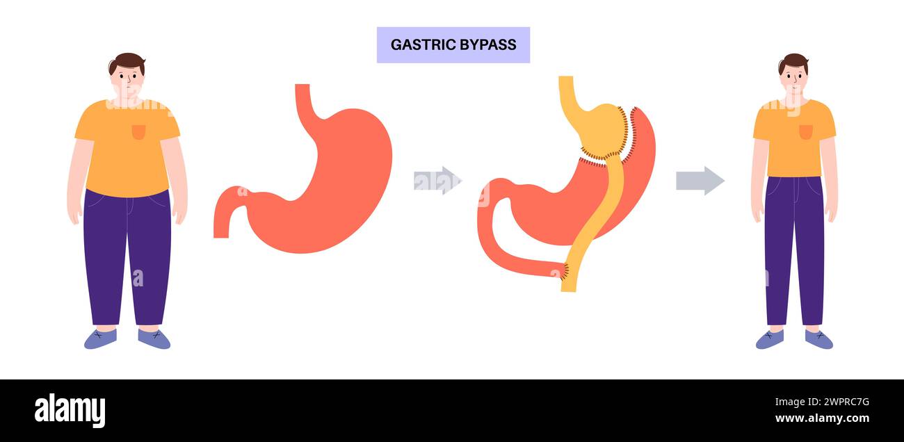 Gastric bypass surgery, illustration Stock Photo - Alamy