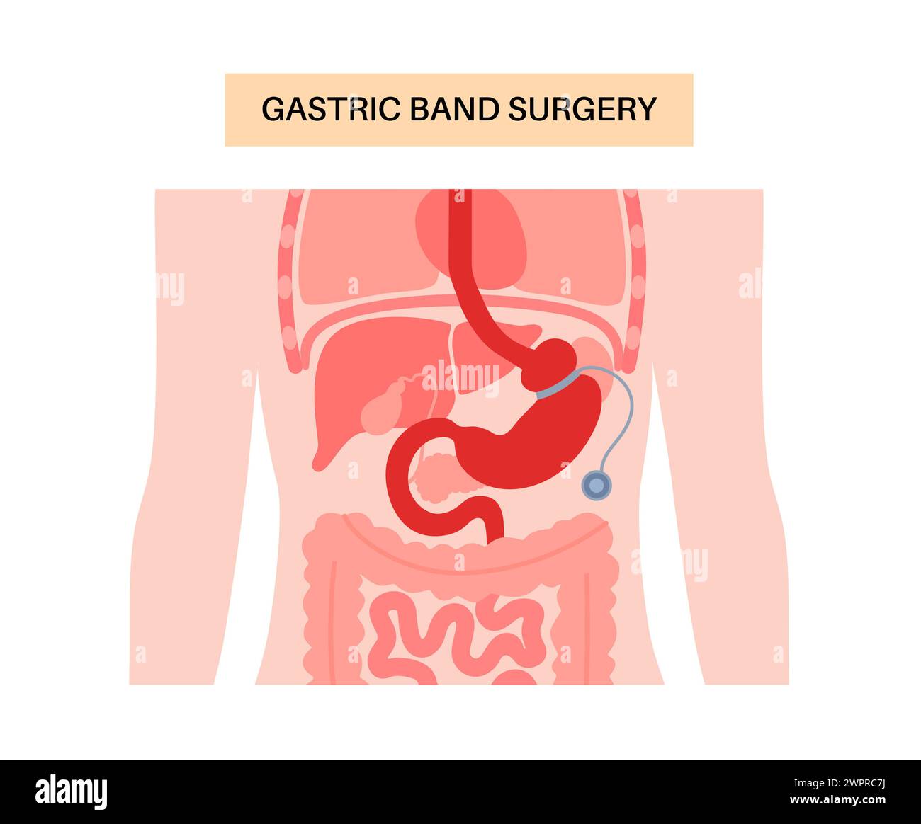Gastric band medical procedure, illustration Stock Photo - Alamy