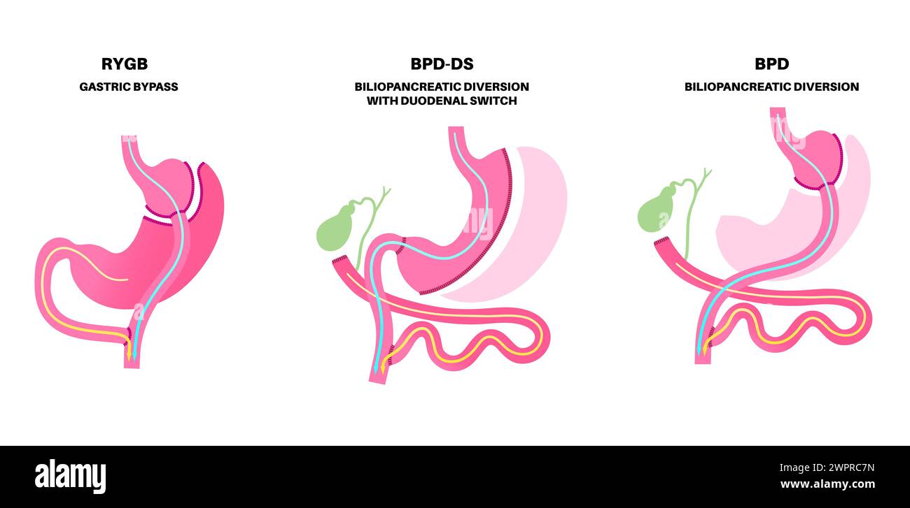 Biliopancreatic diversion (BPD) with duodenal switch and gastric bypass. Stomach surgery weight ...