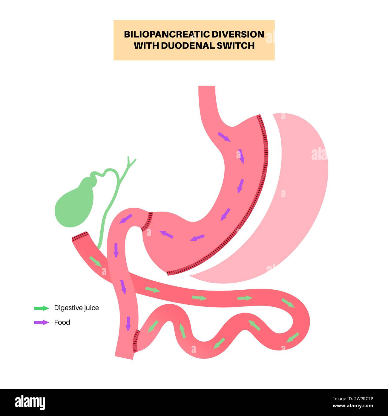 Biliopancreatic diversion (BPD) with duodenal switch, illustration ...