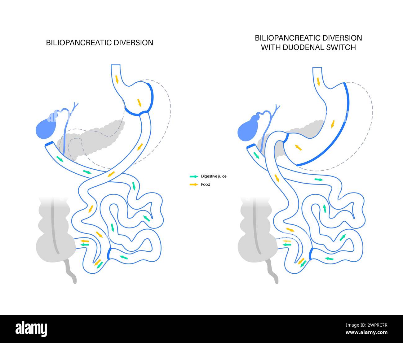 Biliopancreatic diversion (BPD) with duodenal switch, illustration. BPD ...