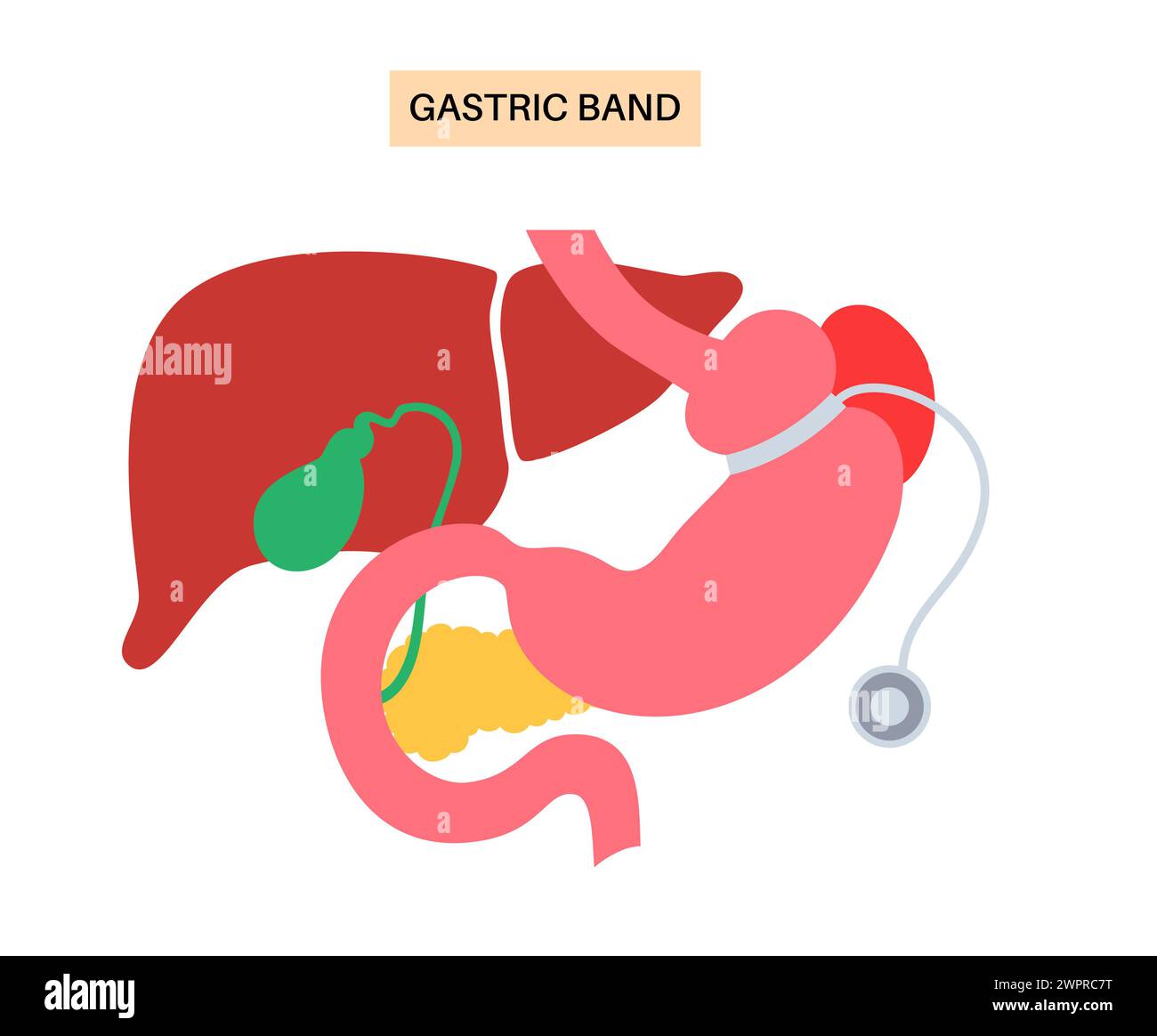 Gastric band medical procedure, illustration. Adjustable gastric ... Gastric band medical procedure, illustration. Adjustable gastric ...
