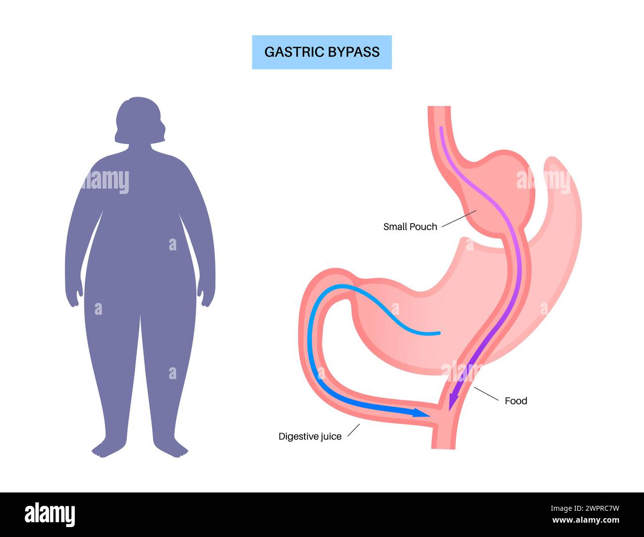 Gastric bypass surgery, illustration Stock Photo - Alamy