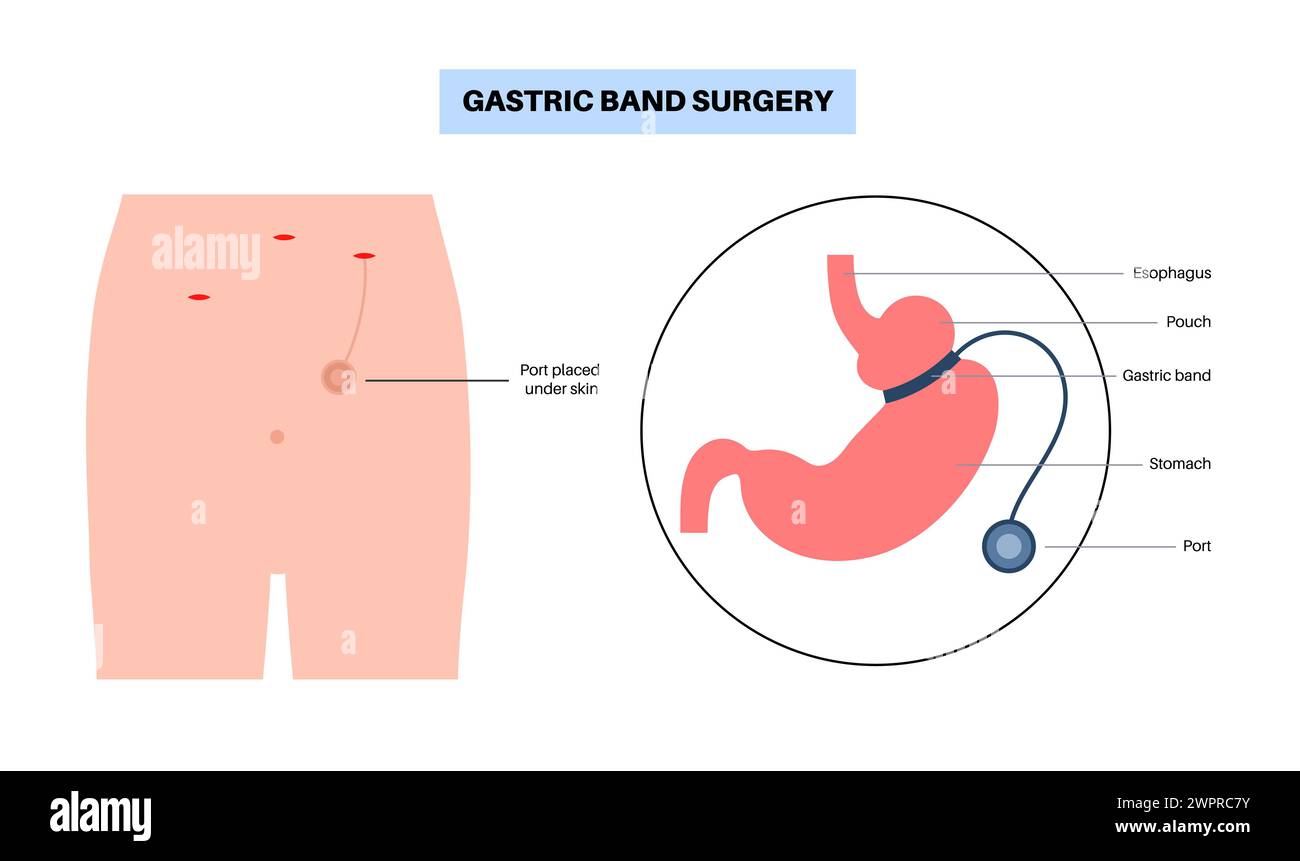 Gastric band medical procedure, illustration. Adjustable gastric ... Gastric band medical procedure, illustration. Adjustable gastric ...