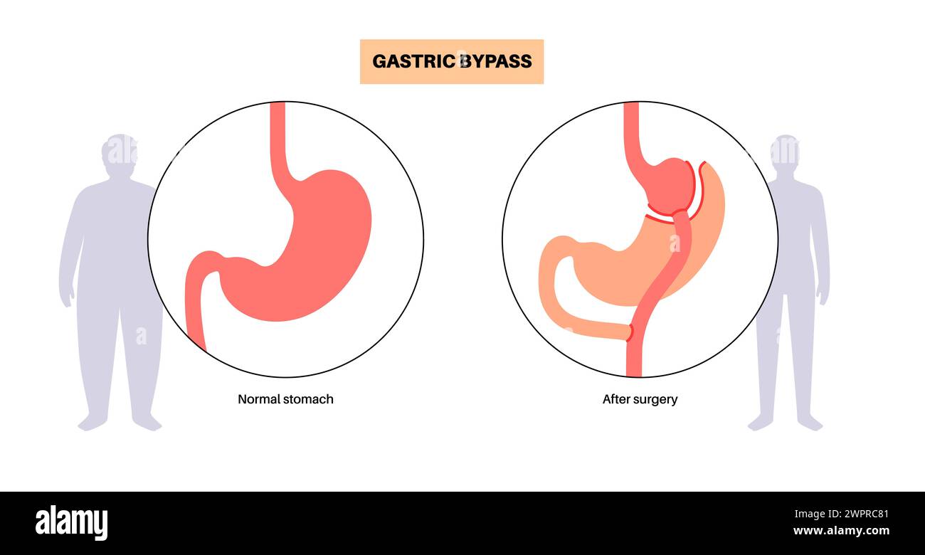 Gastric bypass surgery, illustration Stock Photo - Alamy