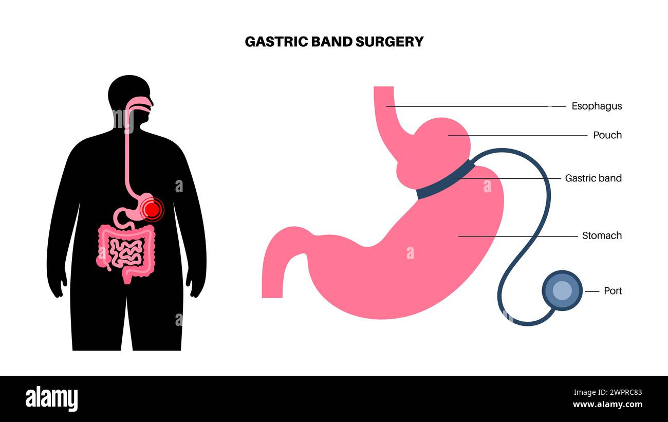 Gastric band medical procedure, illustration. Adjustable gastric ... Gastric band medical procedure, illustration. Adjustable gastric ...