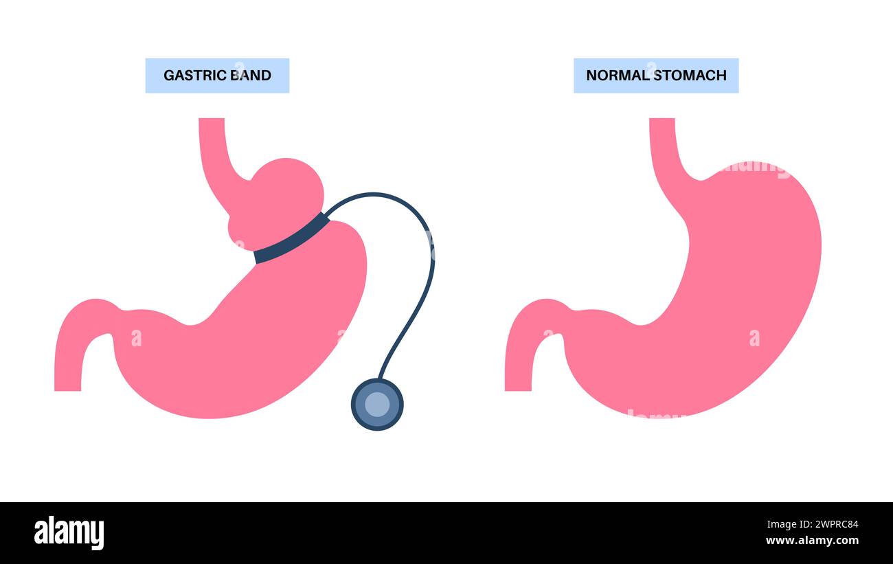Gastric band medical procedure, illustration. Adjustable gastric ... Gastric band medical procedure, illustration. Adjustable gastric ...