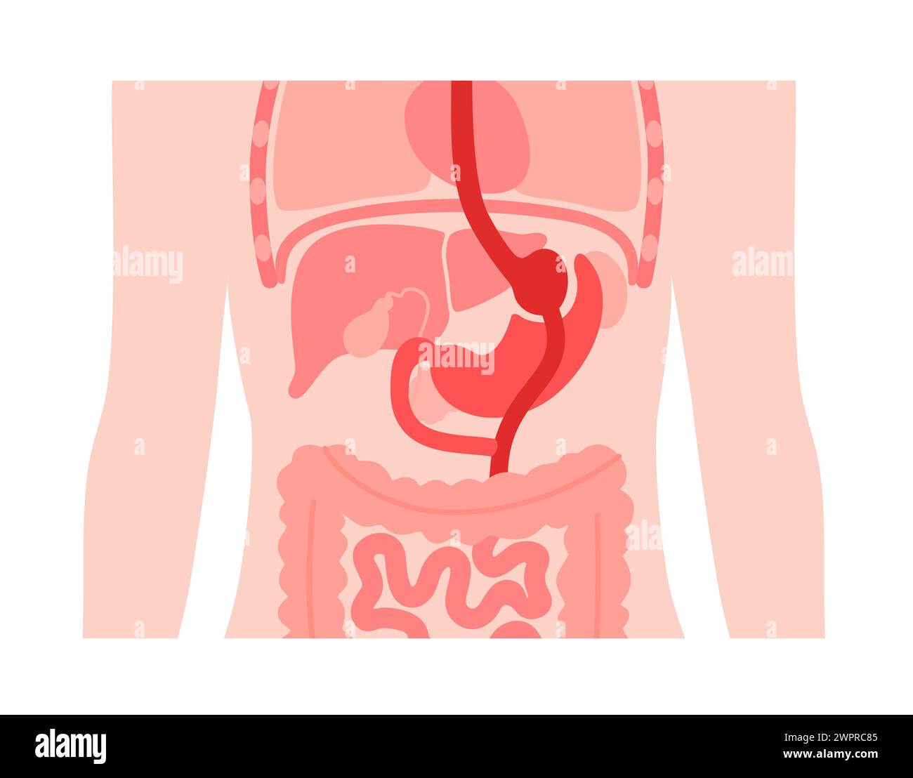 Gastric bypass surgery, illustration Stock Photo - Alamy