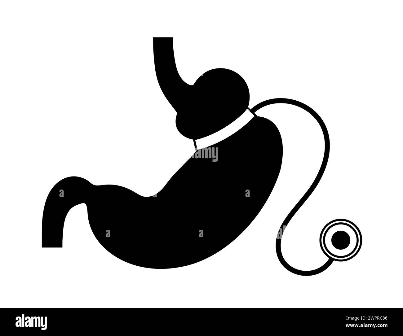 Gastric band medical procedure, illustration. Adjustable gastric ... Gastric band medical procedure, illustration. Adjustable gastric ...