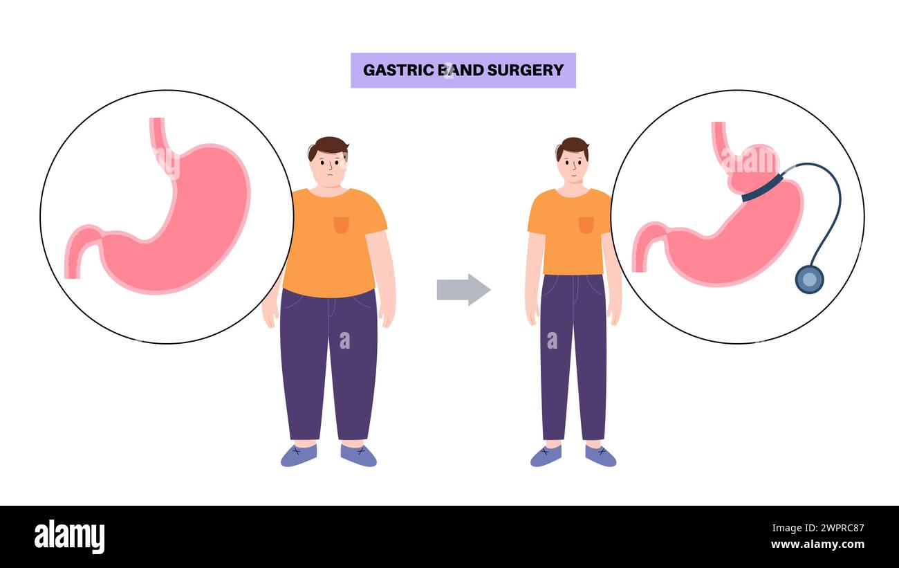 Gastric band medical procedure, illustration. Adjustable gastric ... Gastric band medical procedure, illustration. Adjustable gastric ...