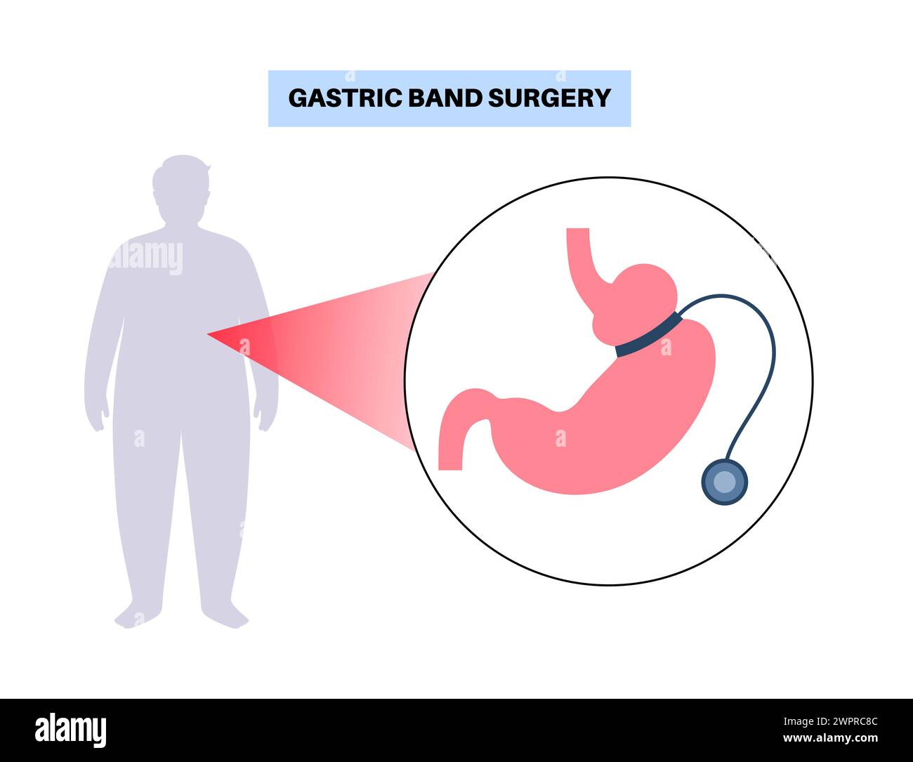 Gastric band medical procedure, illustration. Adjustable gastric ... Gastric band medical procedure, illustration. Adjustable gastric ...