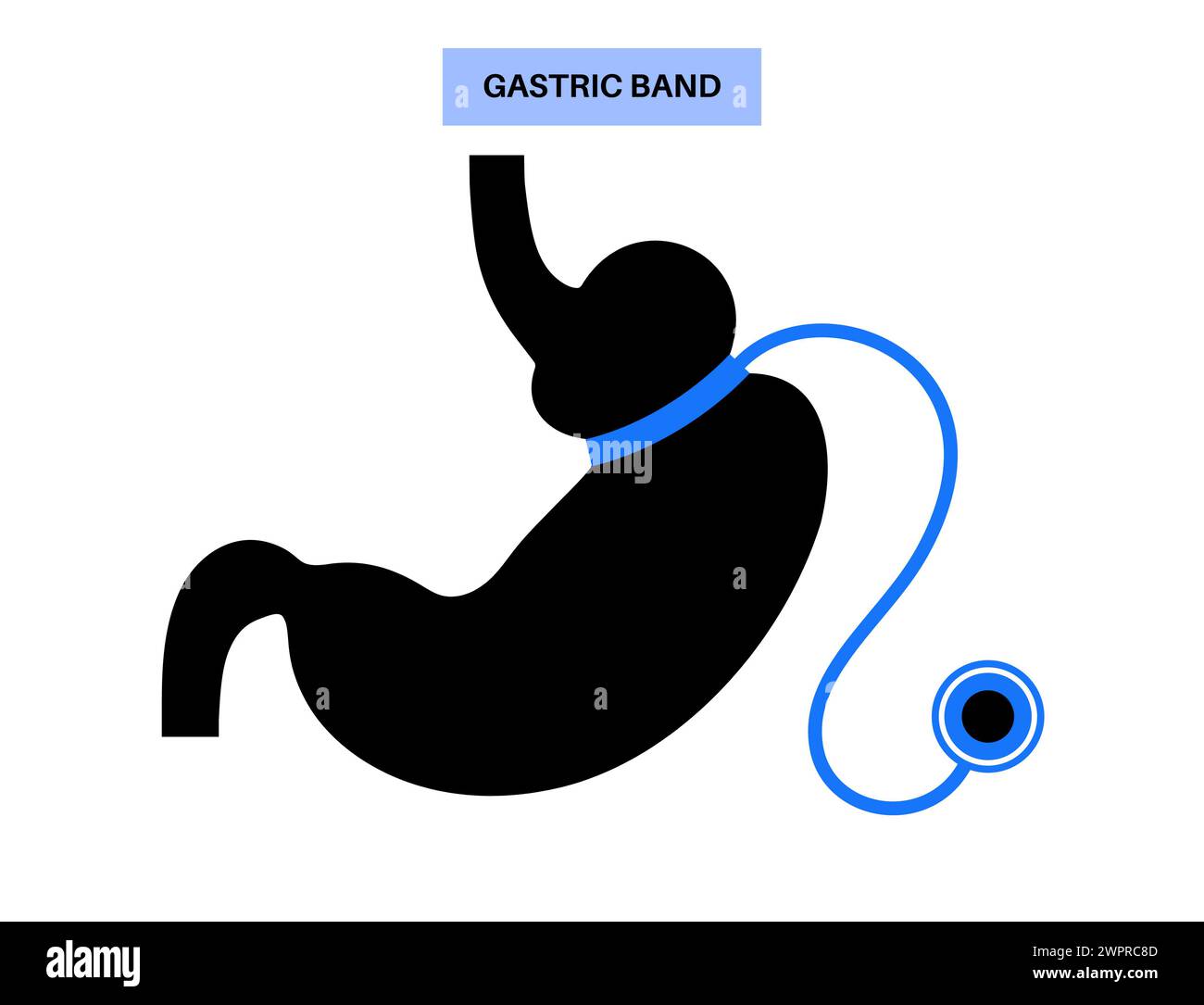 Gastric band medical procedure, illustration Stock Photo - Alamy