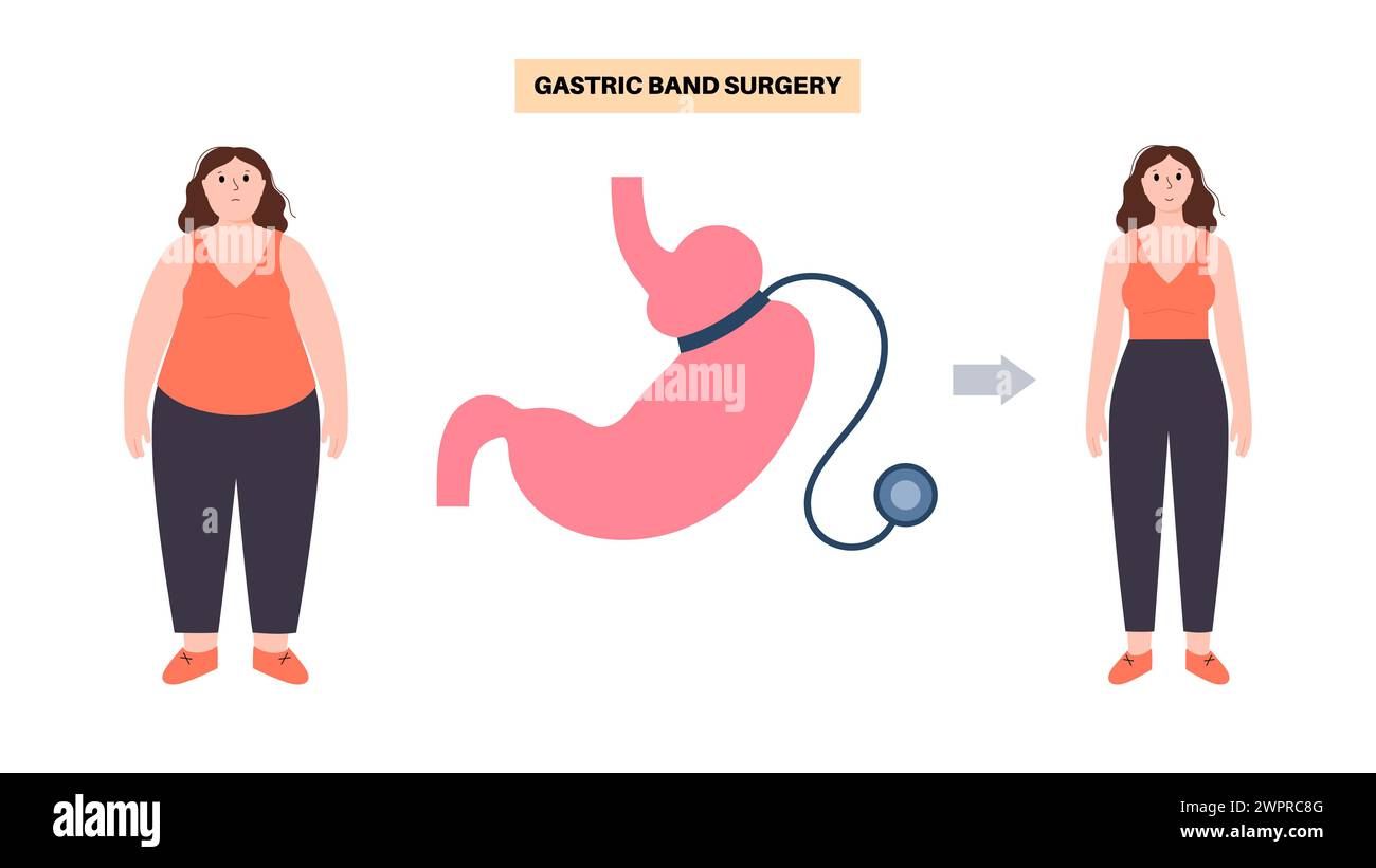 Laparoscopic adjustable gastric banding hi-res stock photography and ...