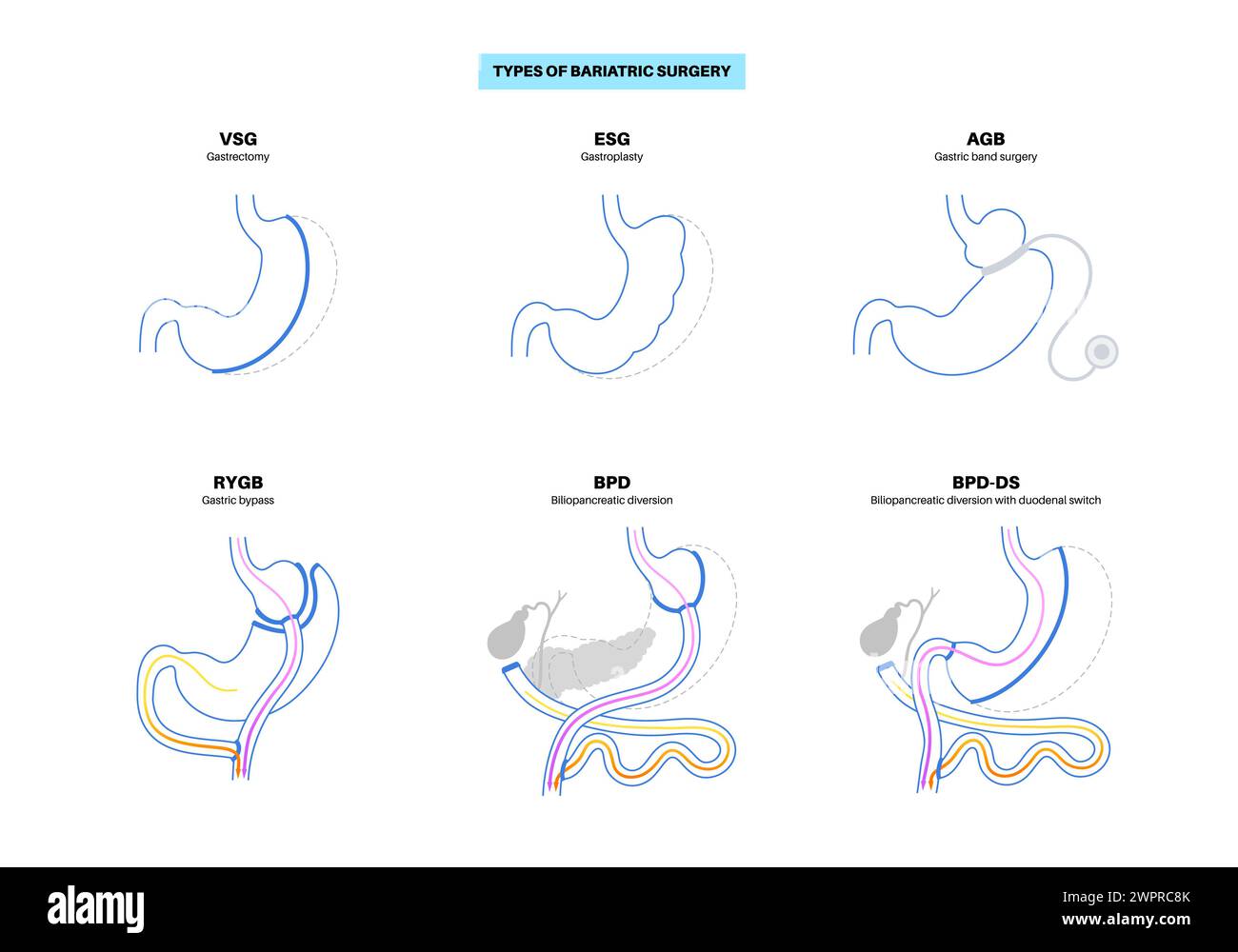 Types of bariatric surgery, illustration Stock Photo - Alamy
