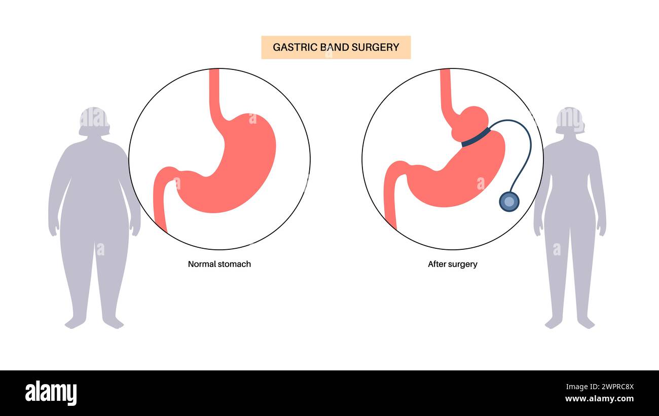 Gastric band medical procedure, illustration. Adjustable gastric ... Gastric band medical procedure, illustration. Adjustable gastric ...