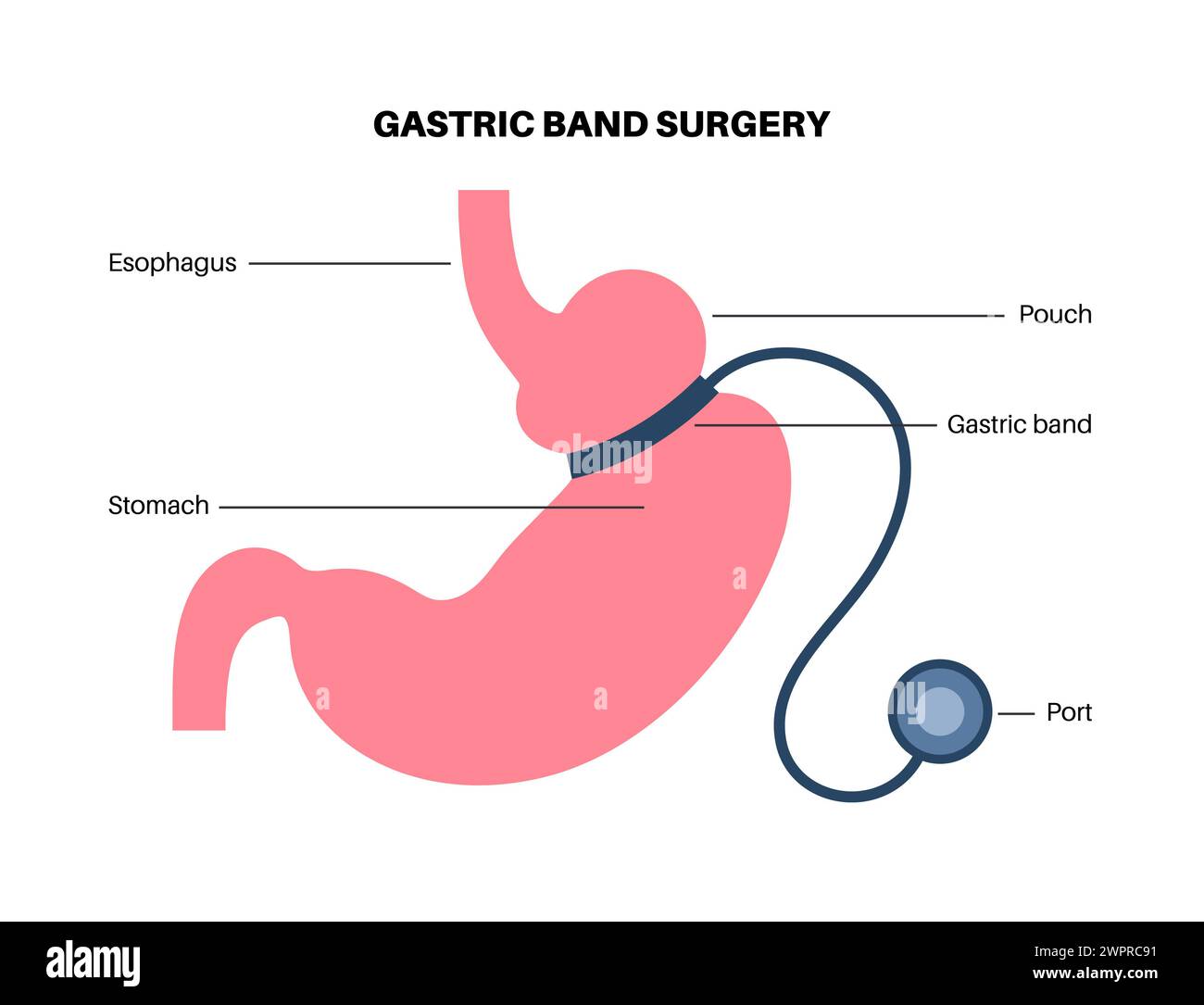 Gastric band medical procedure, illustration. Adjustable gastric ... Gastric band medical procedure, illustration. Adjustable gastric ...