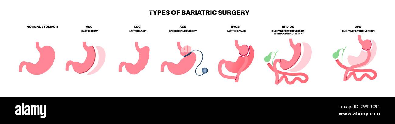 Types of bariatric surgery, illustration. Healthy stomach and internal ...