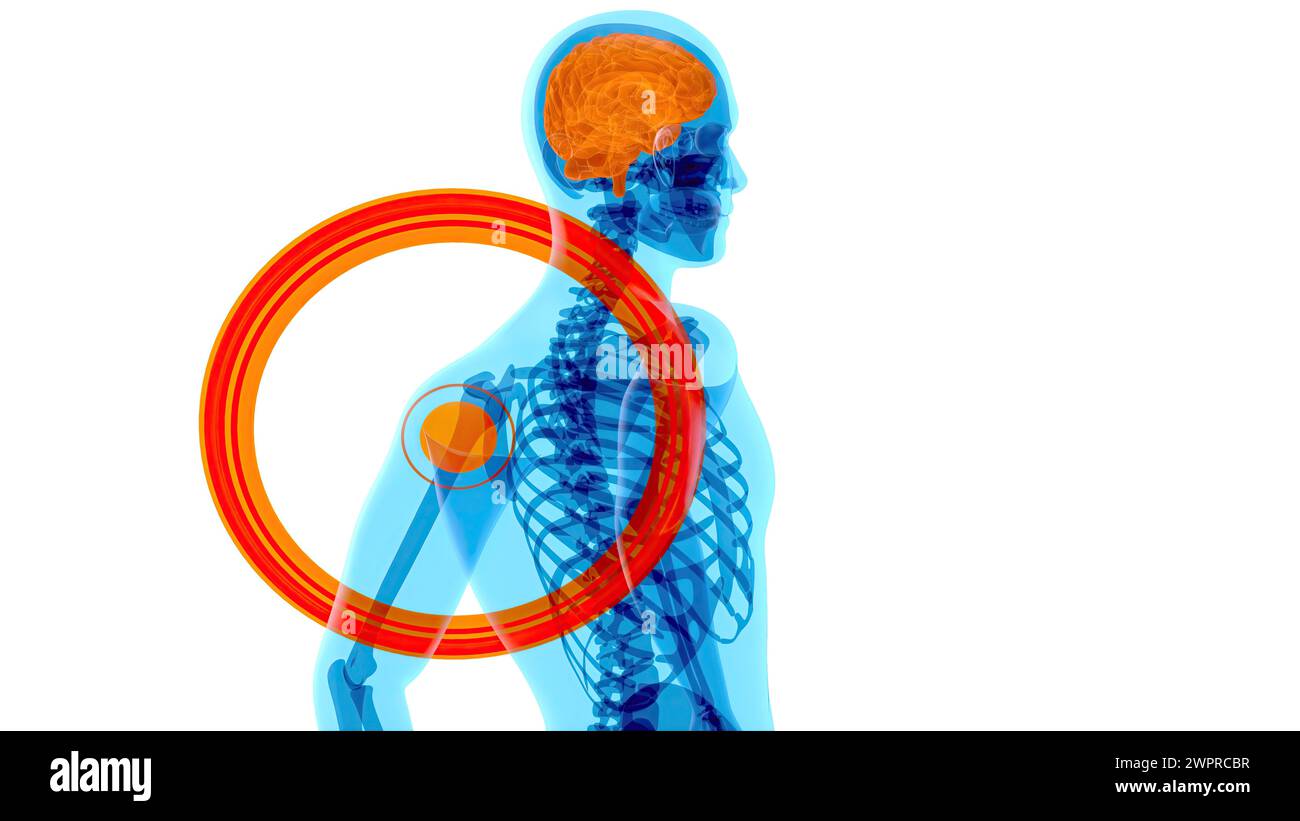 Shoulder pain, conceptual illustration Stock Photo - Alamy Shoulder pain, conceptual illustration Stock Photo - Alamy