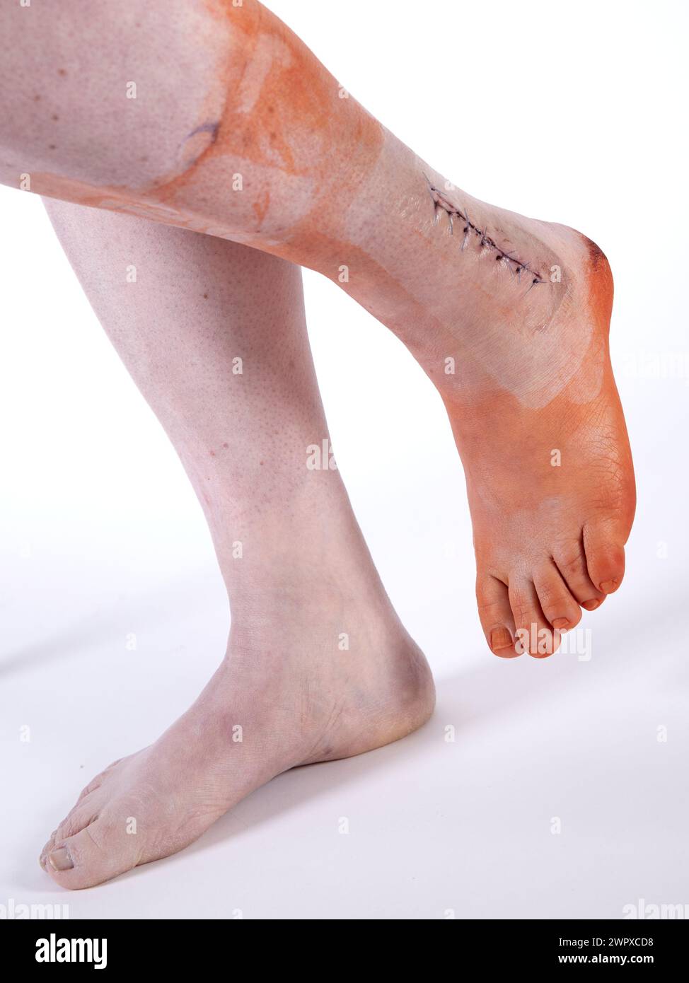 freshly operated leg with a long scar Stock Photo - Alamy
