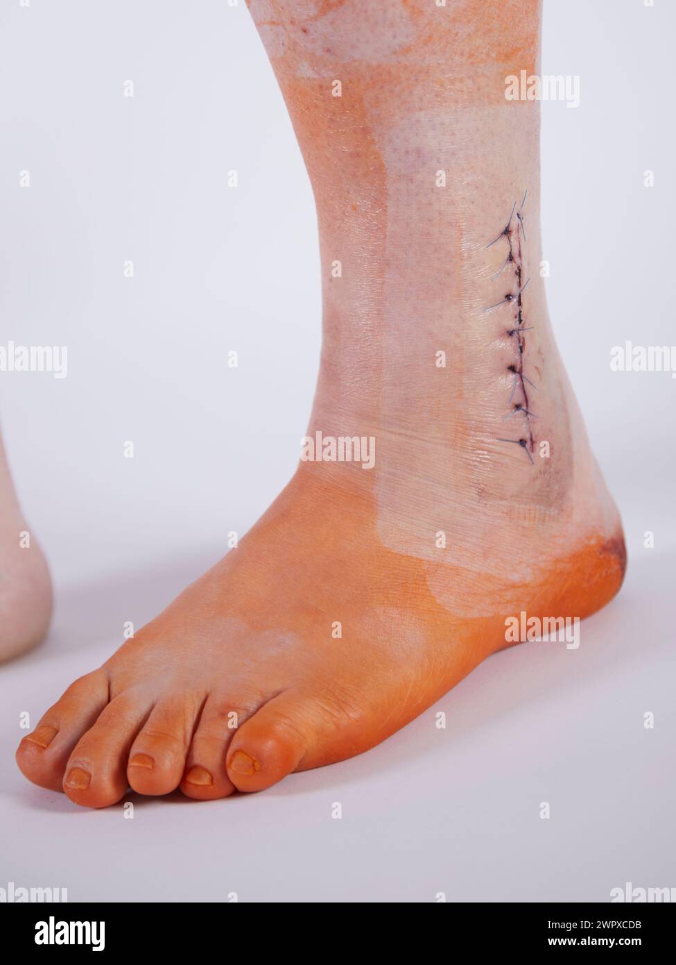 Ankle scar hi-res stock photography and images - Alamy