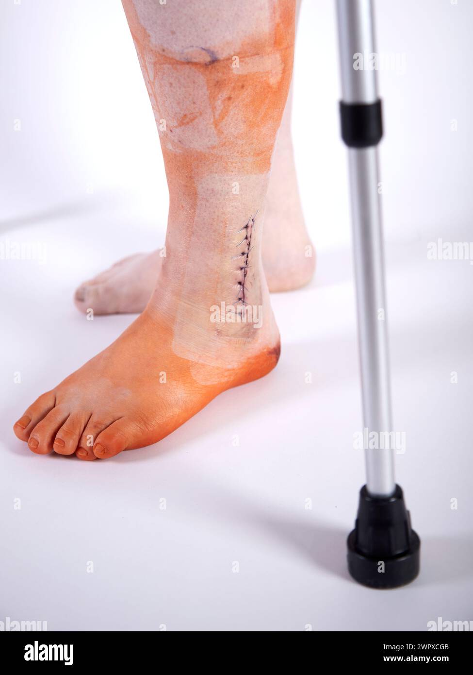 freshly operated leg with a long scar, walking on crutches Stock Photo ...