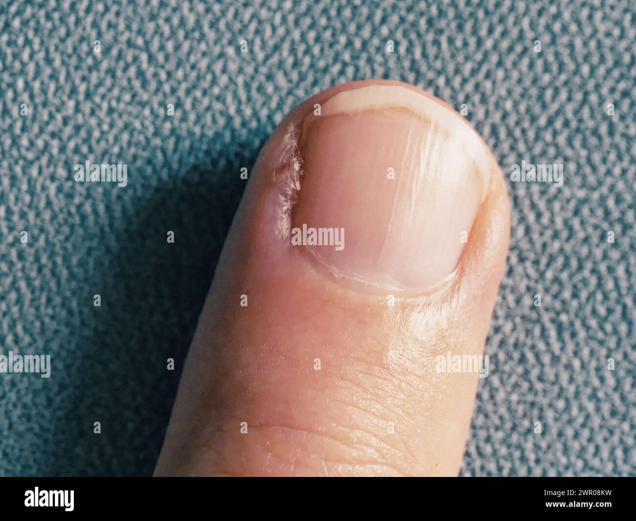 Close up injured finger hi-res stock photography and images - Alamy