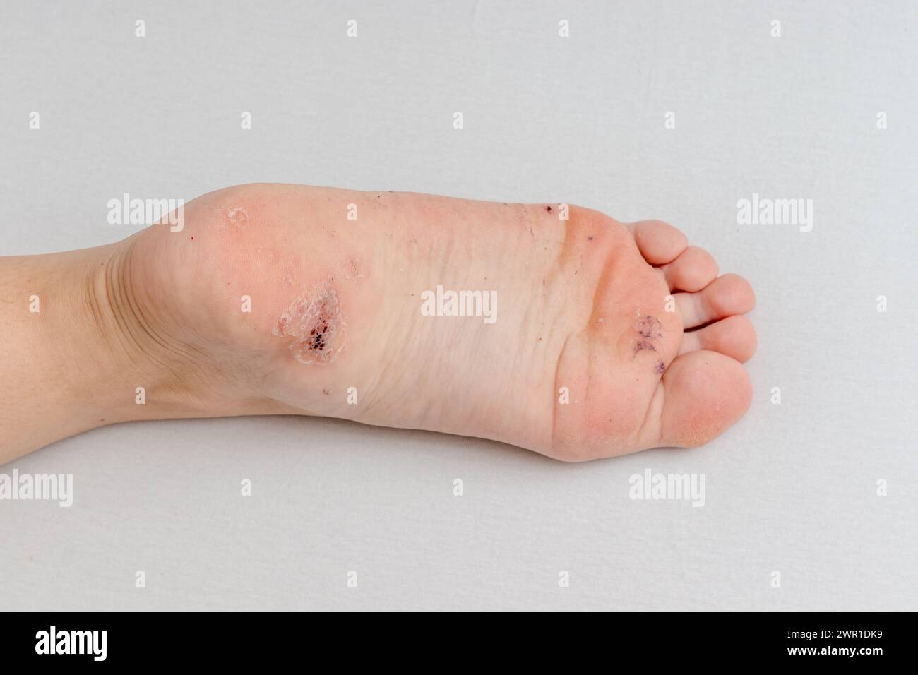 Verruca foot hi-res stock photography and images - Alamy