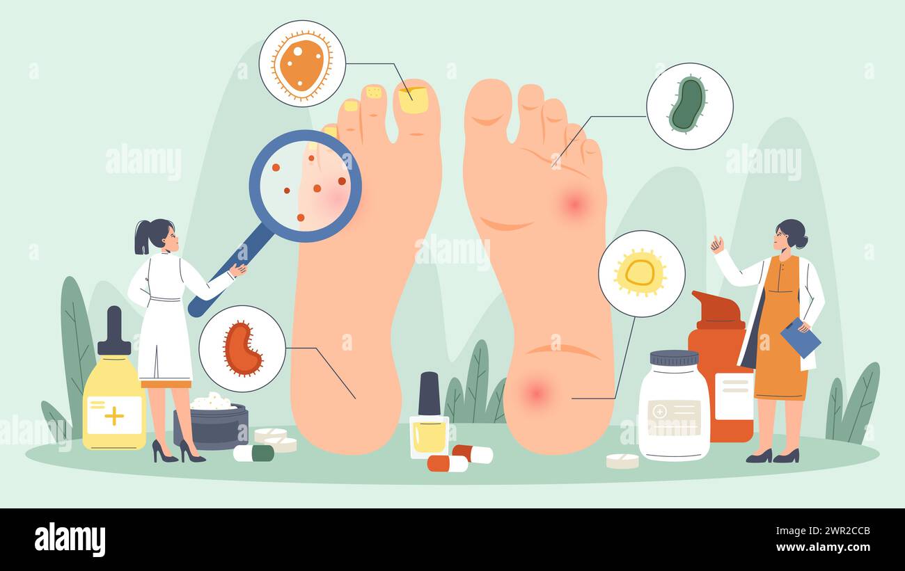 Podiatry concept. Nail and foot disease, medical treatment. Tiny ...