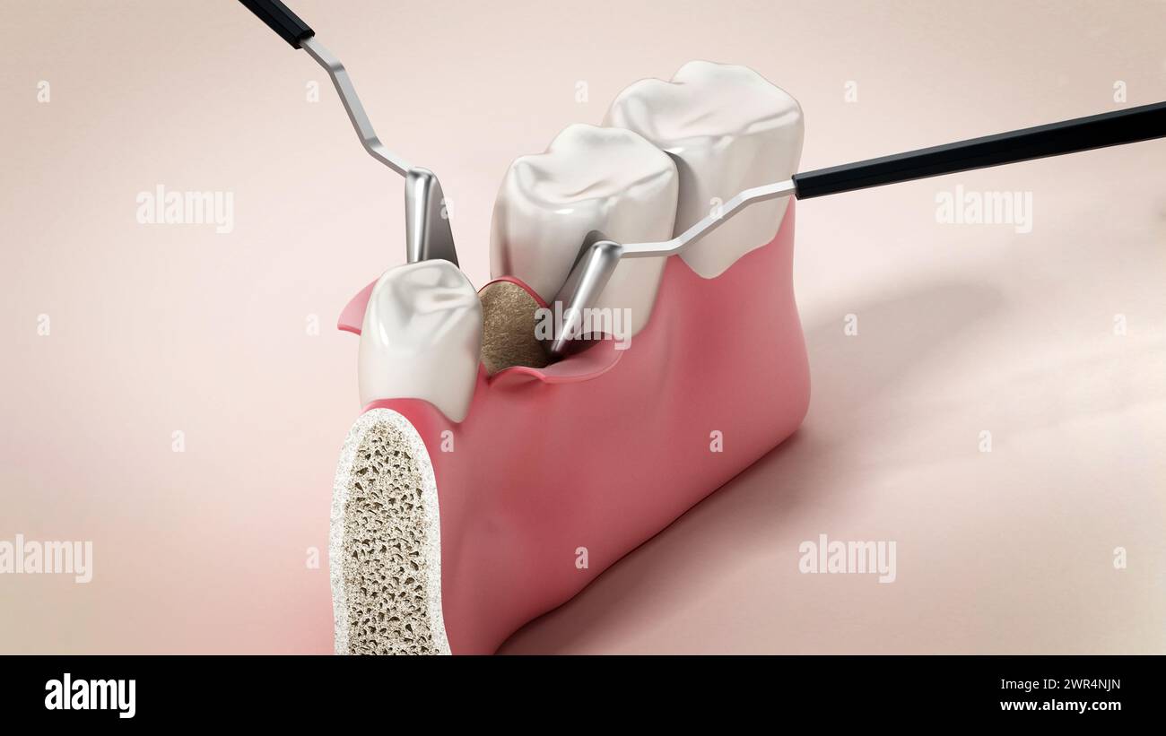 3D illustration of mid-crestal incision dental operation. 3D ...