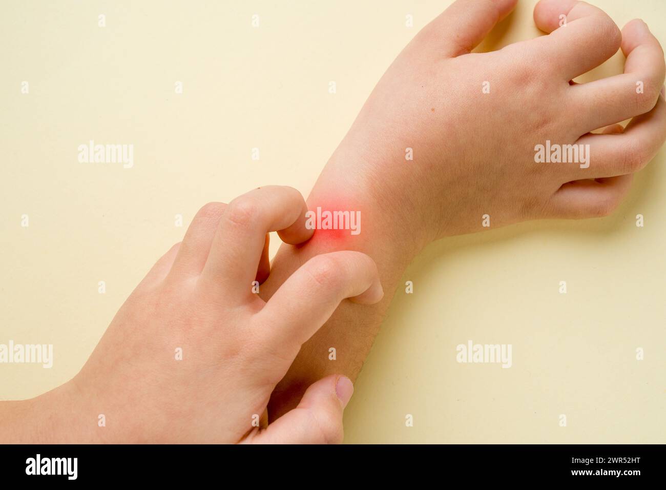 The insect bite on the girl's arm is adjusting and itching Stock Photo ...