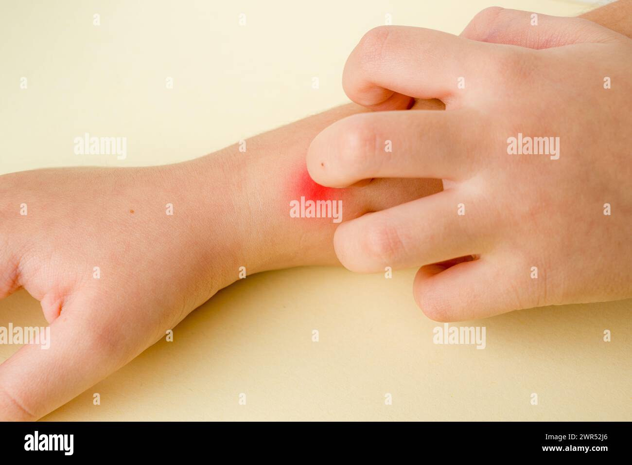 The insect bite on the girl's arm is adjusting and itching Stock Photo ...