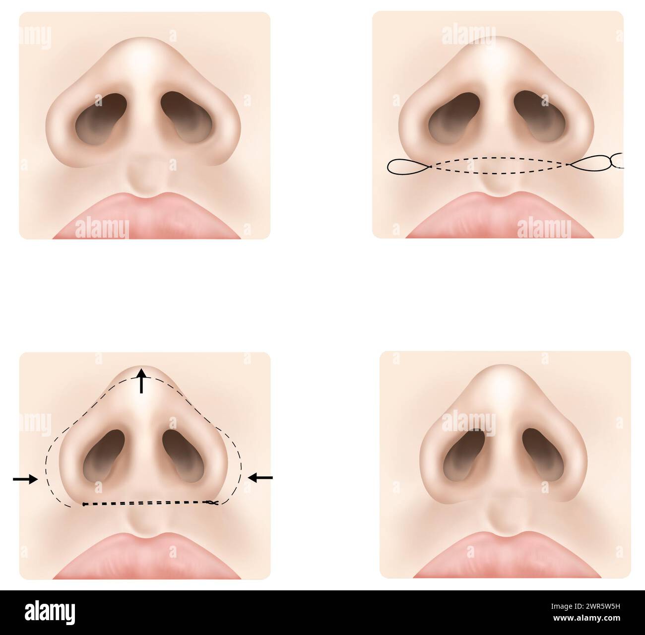 Rhinoplasty hi-res stock photography and images - Alamy