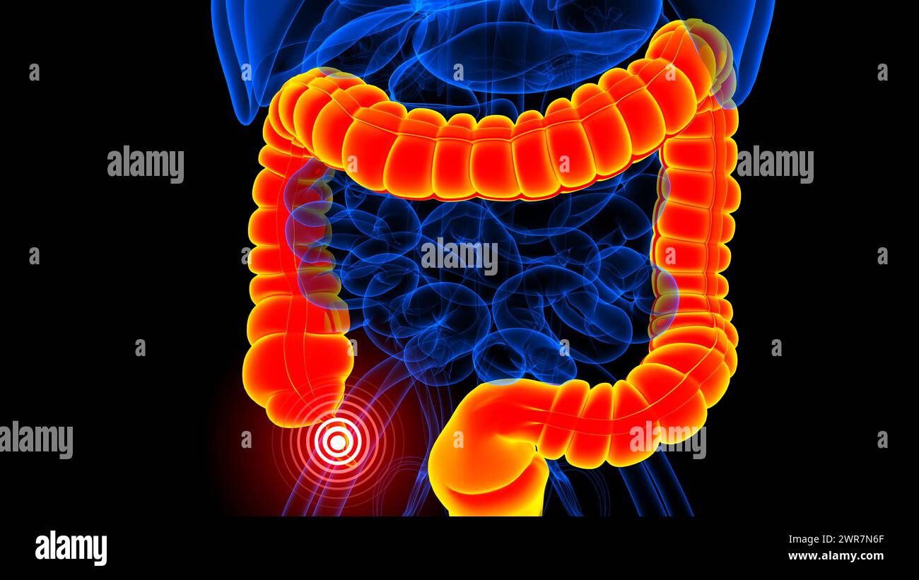 appendix pain anatomy for medical concept 3d illustration Stock Photo ...