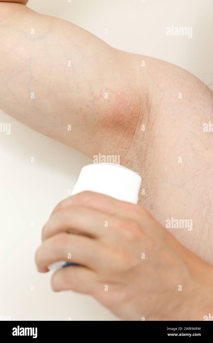 Shaving rash hi-res stock photography and images - Alamy