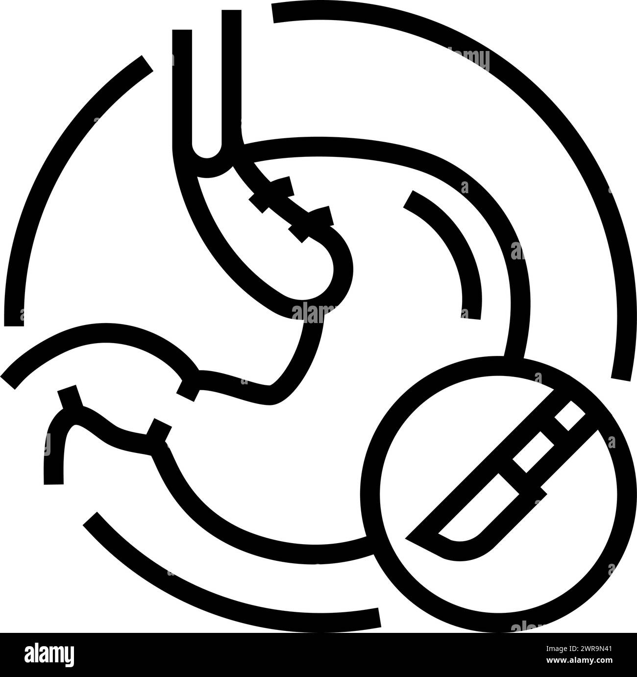 Nissen fundoplication Cut Out Stock Images & Pictures - Alamy