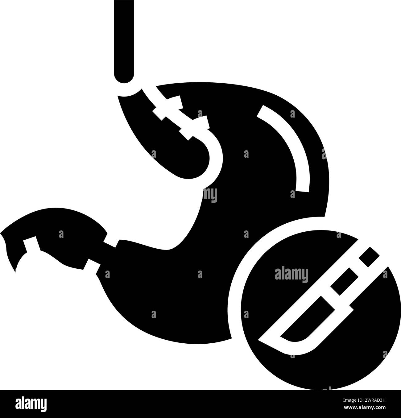 Nissen fundoplication hi-res stock photography and images - Alamy