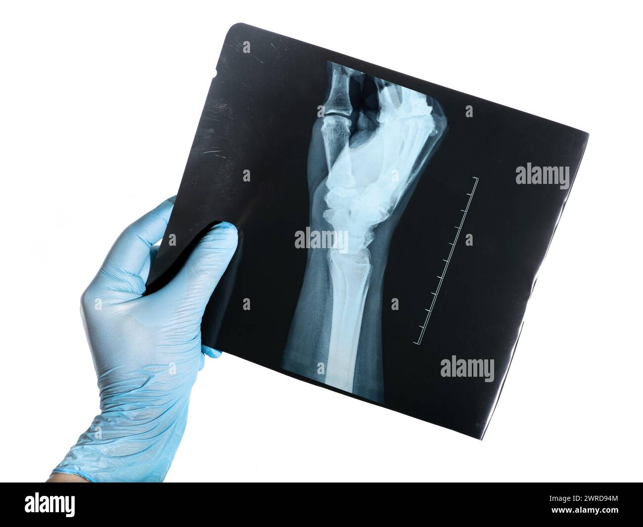 Scaphoid fracture xray hi-res stock photography and images - Alamy