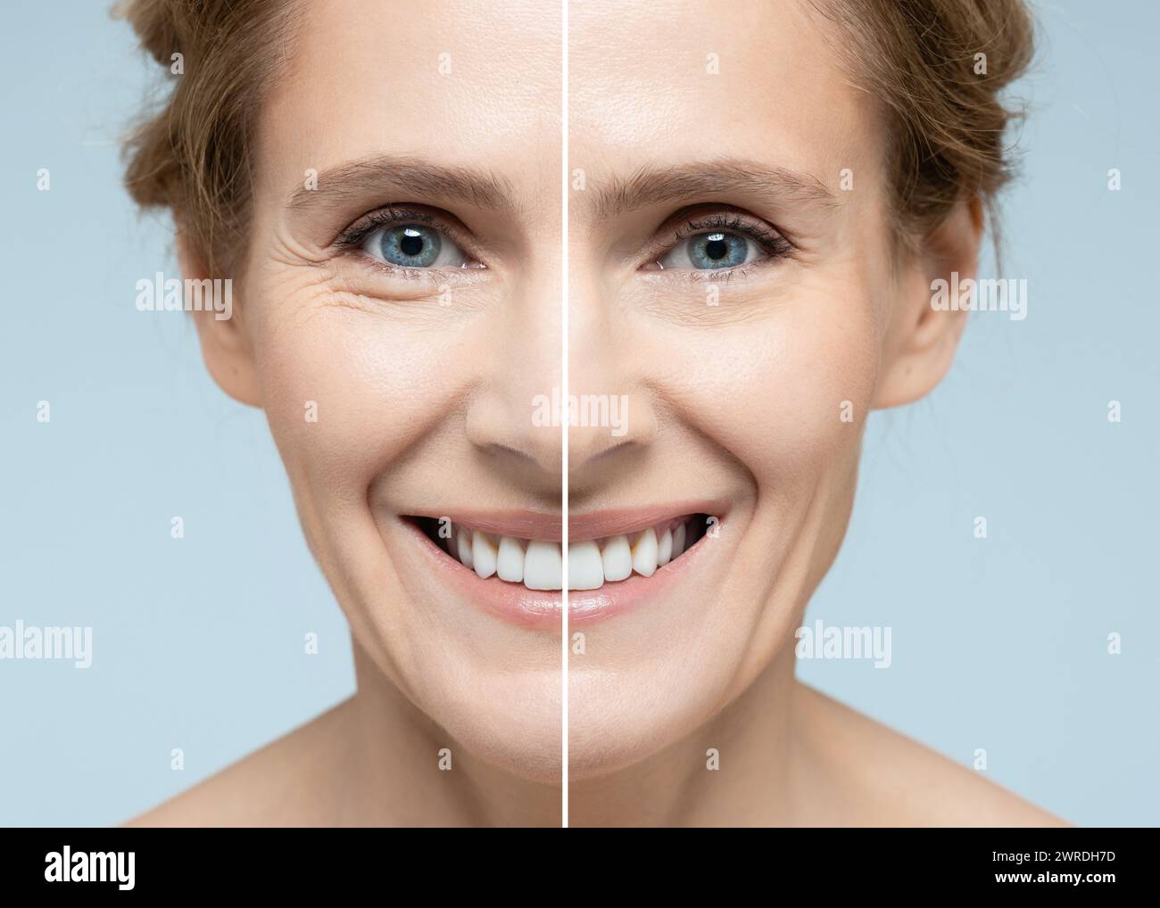Woman's face before and after skin tightening and anti-aging procedures ...